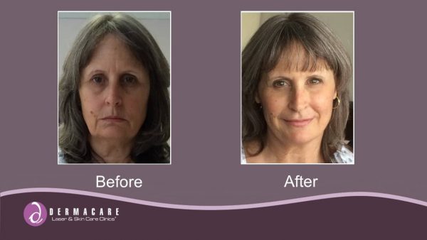 VOLUX XC® for Jawline in Gainesville FL | Dermacare