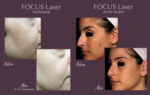 PicoSure FOCUS Laser in Gainesville, Florida | Dermacare