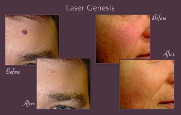 Laser Genesis in Gainesville, Florida | Dermacare Gainesville