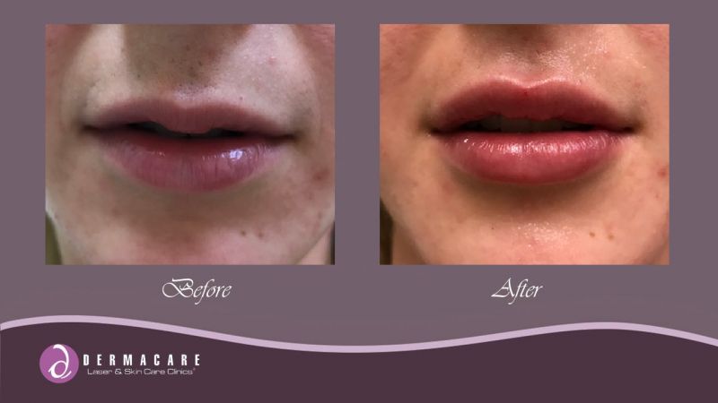 Juvederm® Ultra XC for Lips in Gainesville FL | Dermacare