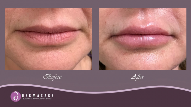 Juvederm® Ultra XC for Lips in Gainesville FL | Dermacare