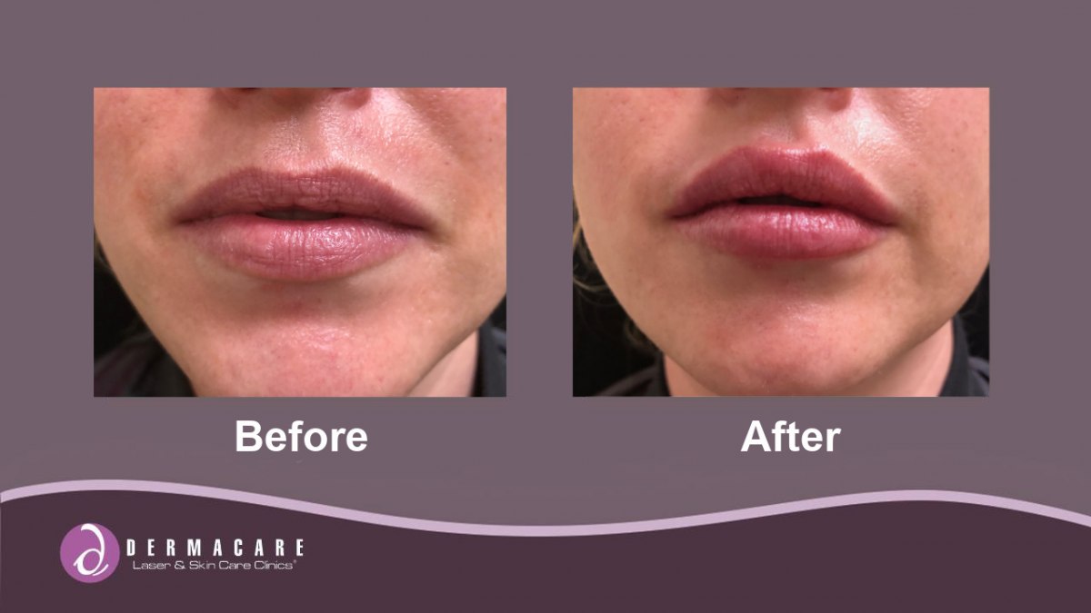 Juvederm® Ultra XC for Lips in Gainesville FL | Dermacare