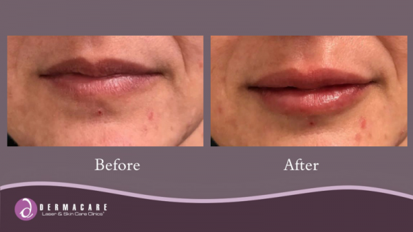 Volbella® XC for Lips in Gainesville FL | Dermacare