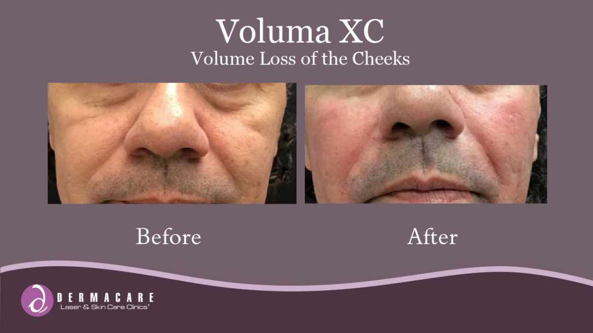 Juvederm Voluma® for Cheeks in Gainesville FL | Dermacare