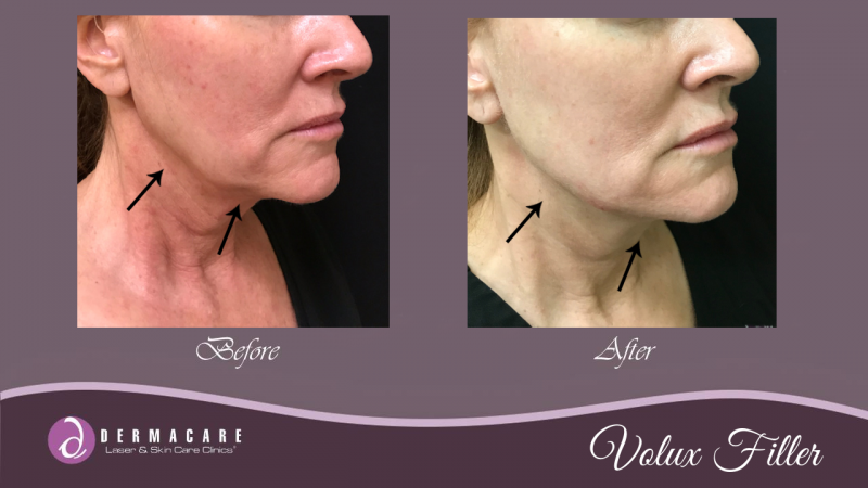 VOLUX XC® for Jawline in Gainesville FL | Dermacare